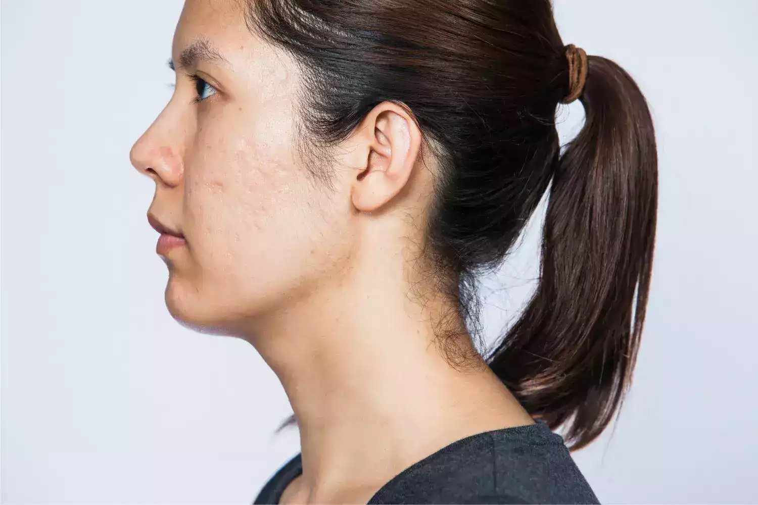 Facing Acne How Specifically To Cope Using its Effects - 52 Key Week